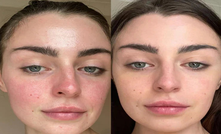 Skin Flushing: What Is Flushed Skin, Common Causes, and Why Your Face ...