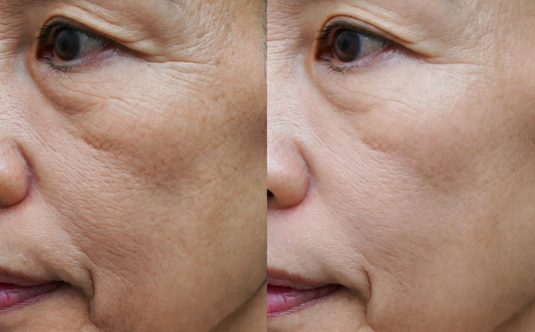 Laser VS IPL: Which Is Better For Hair Removal? – JOVS