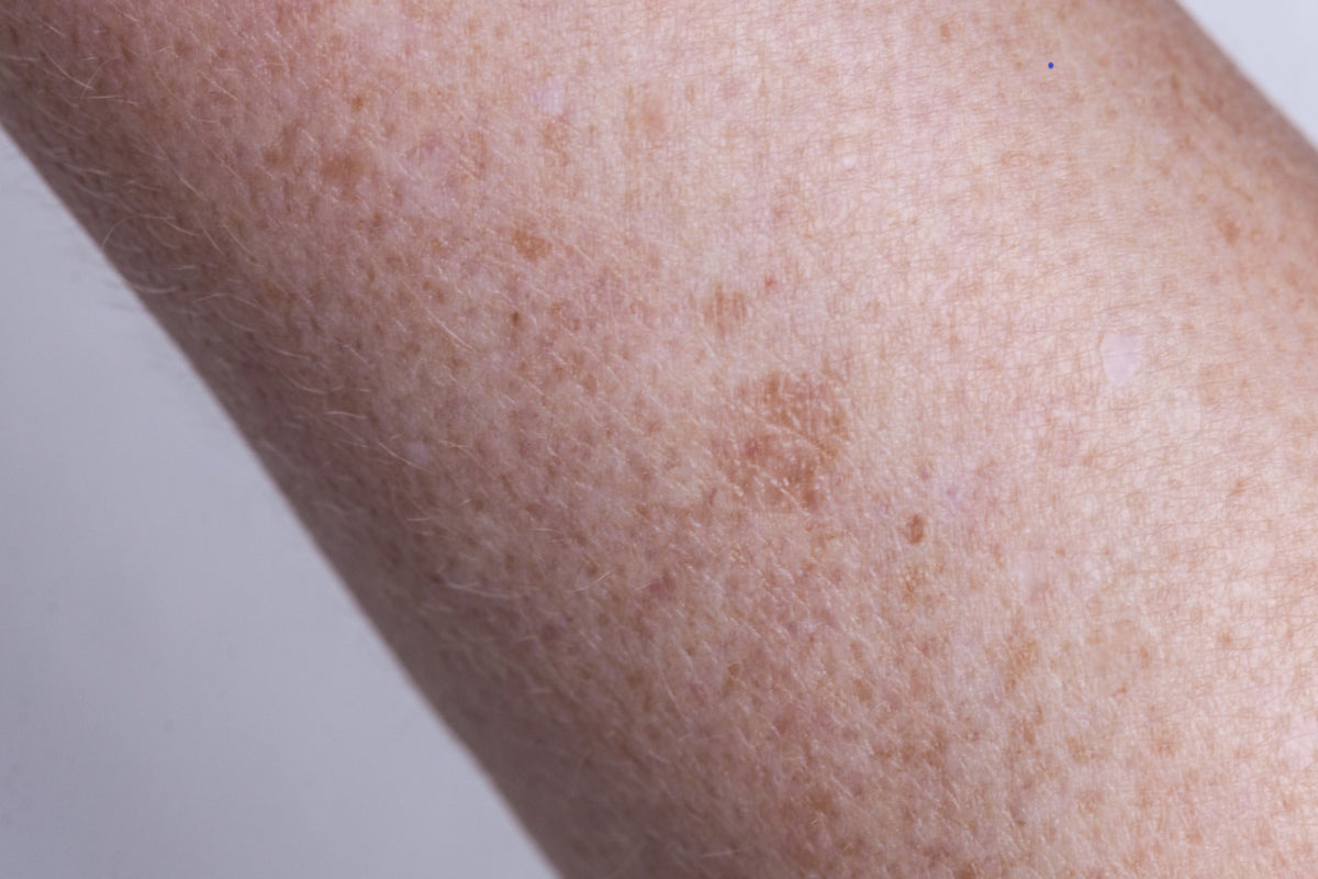 How Red Light Therapy Can Treat Hyperpigmentation – JOVS